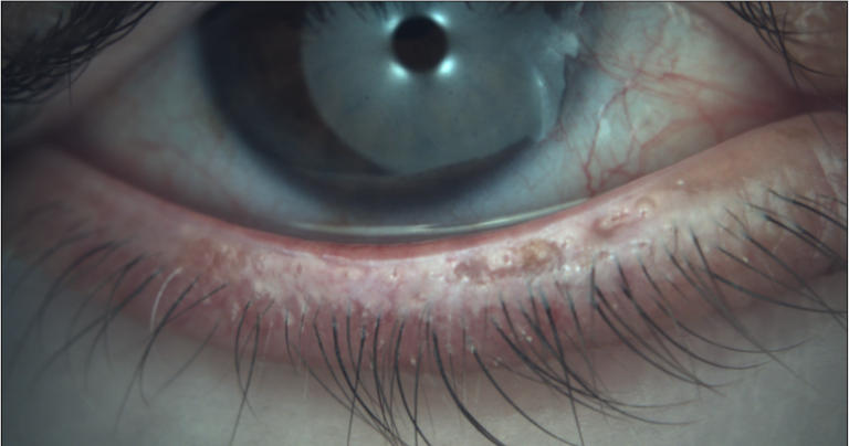 Chalazions, styes, blepharitis... Everything you need to know about ...